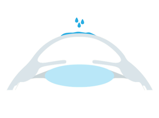 Standard Cataract Surgery - Eyelaser